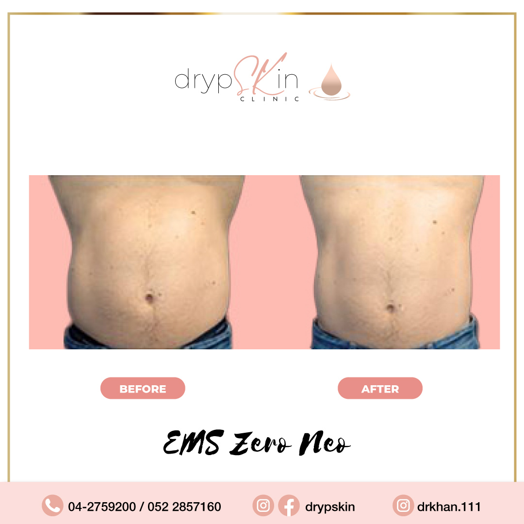 What Does Ems Do For Skin at Tyler Curr blog